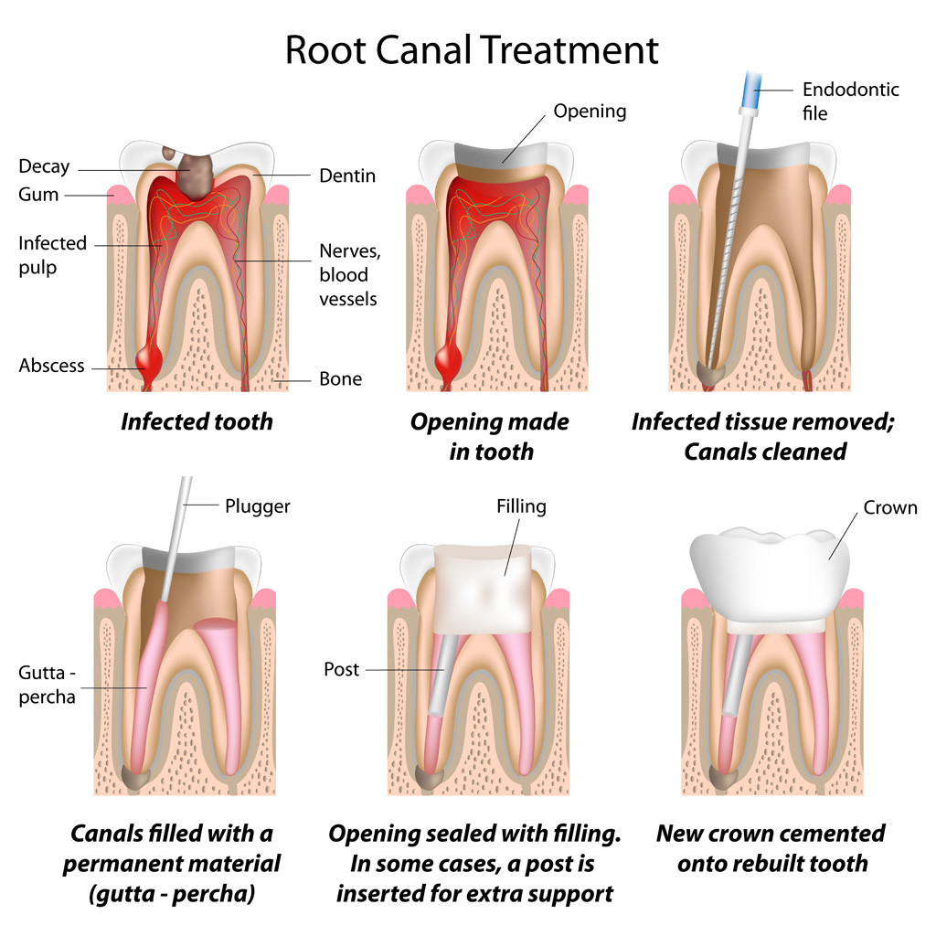 What Can I Expect After Root Canal Treatment Smile Solutions Article